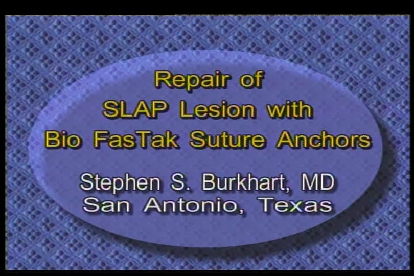 Arthrex - Repair of SLAP Lesion with Bio-FASTak® Suture Anchors