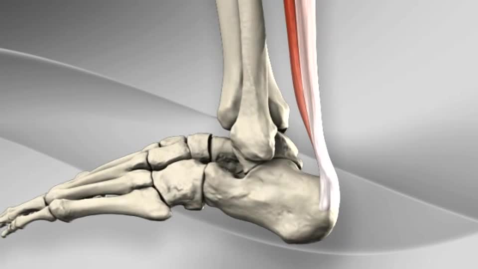 Arthrex - Achilles SutureBridge™