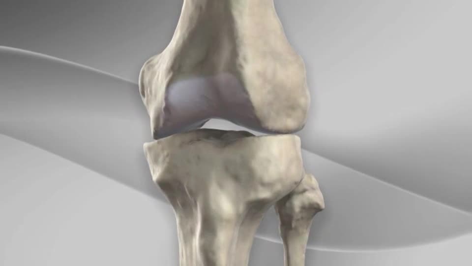 Arthrex - Microfracture with PowerPick™ Device