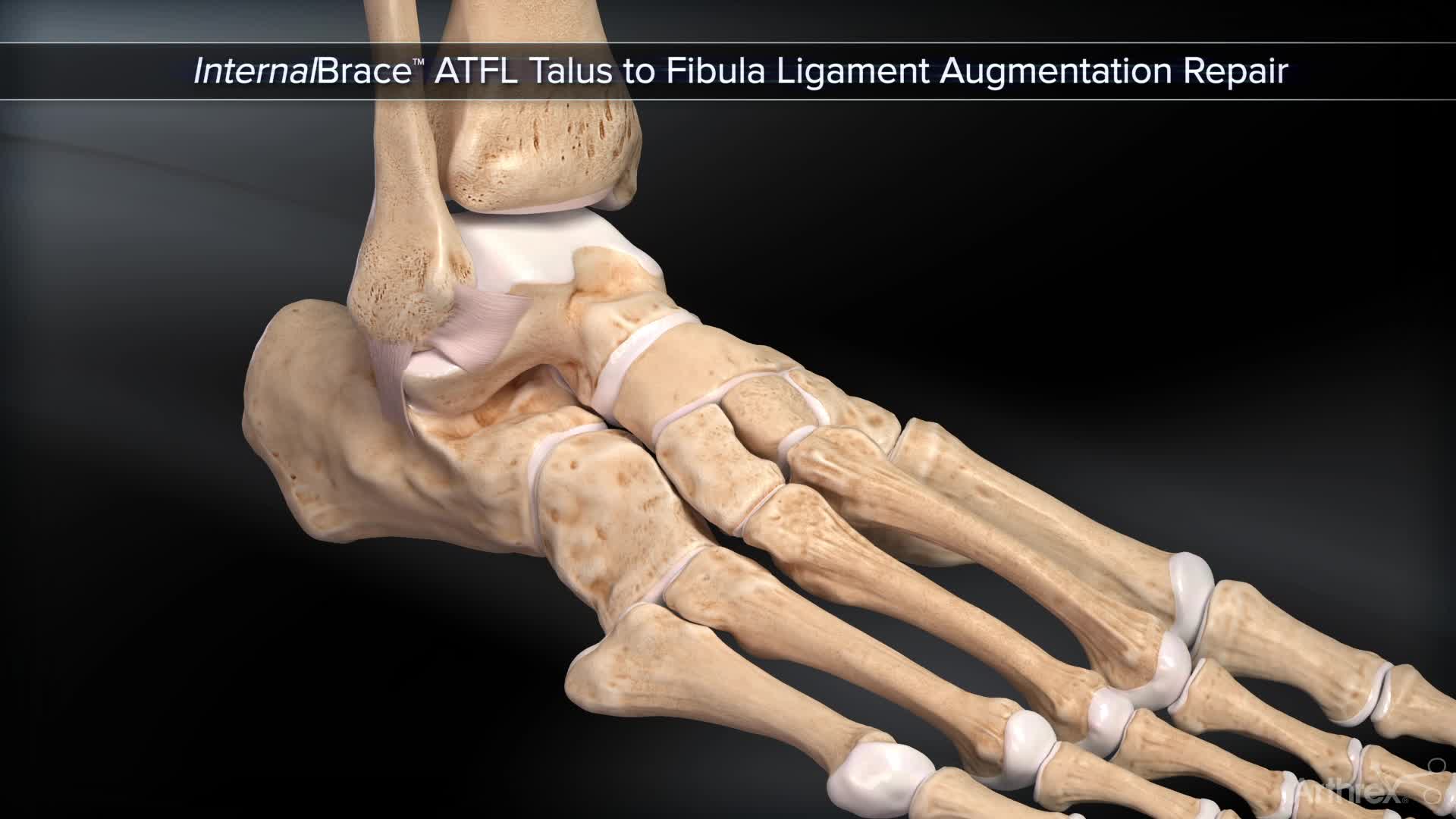 Arthrex - InternalBrace™ ATFL Talus to Fibula Ligament Augmentation Repair