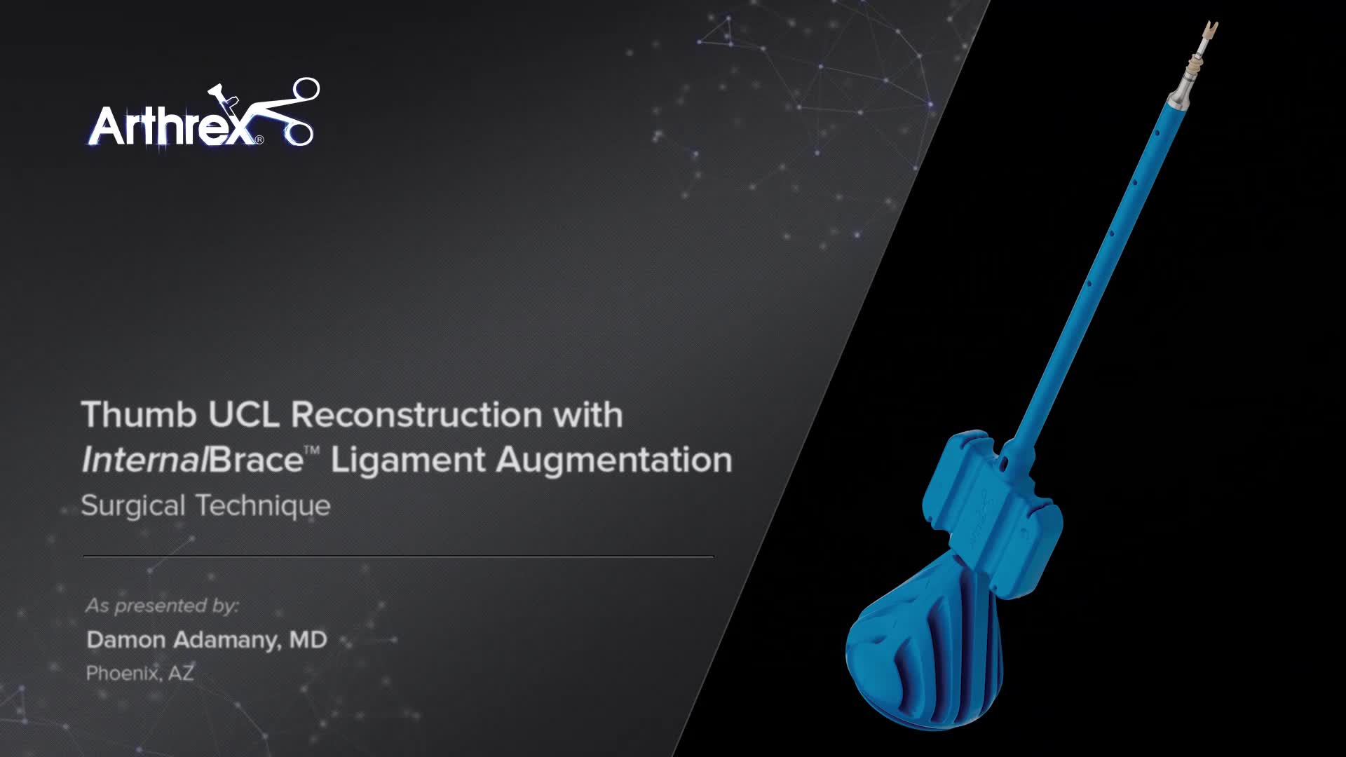 Arthrex - Thumb UCL Reconstruction With InternalBrace™ Ligament ...
