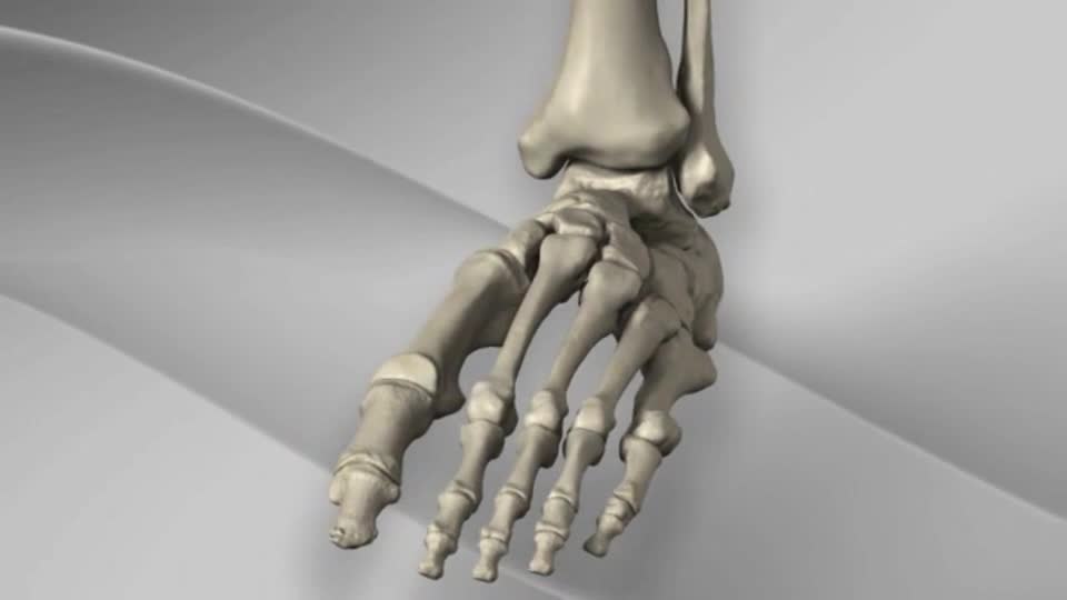 Arthrex - First Metatarsal Phalangeal Joint Fusion with Lapidus Plate ...
