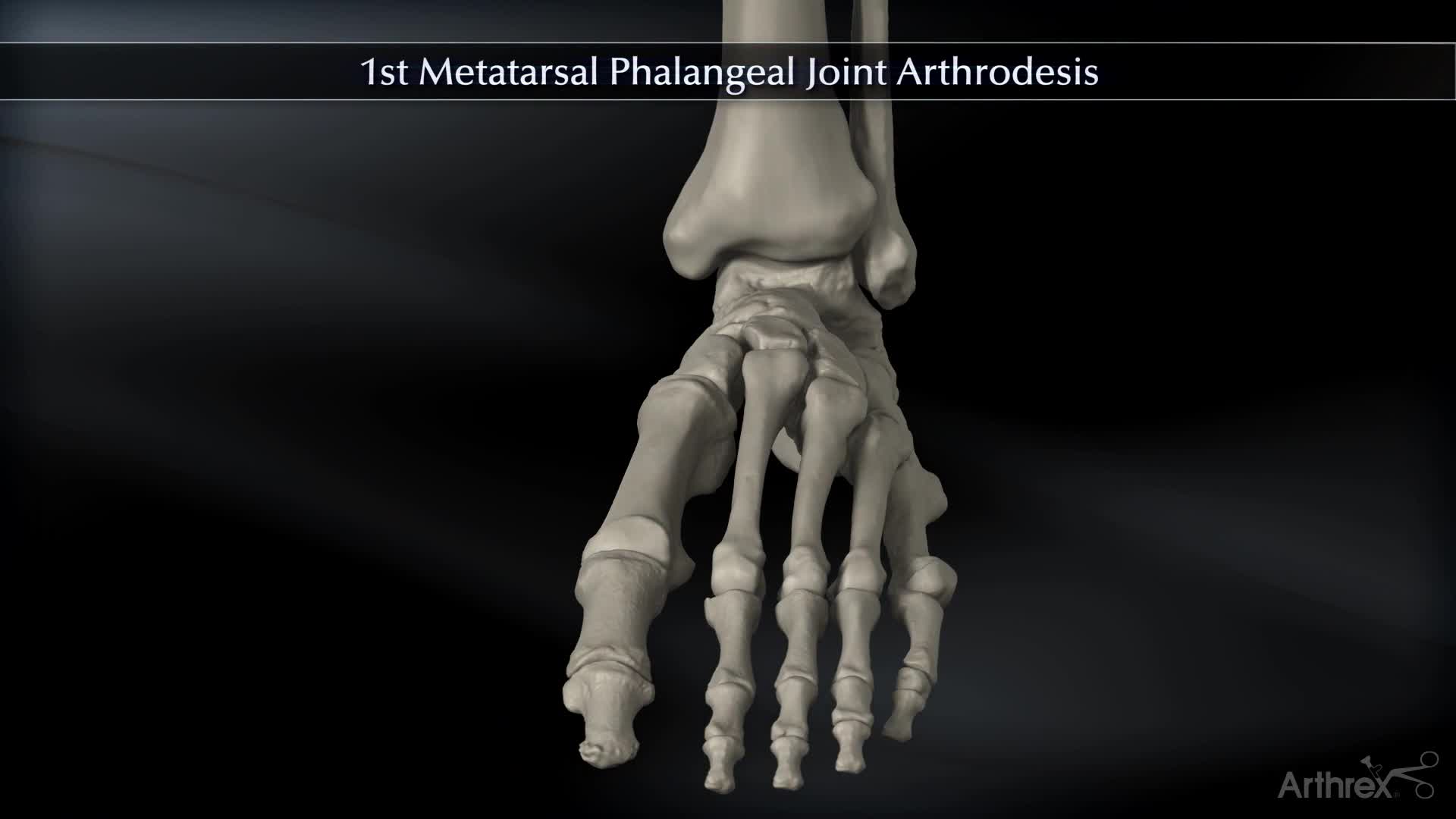 Arthrex - 1st Metatarsal Phalangeal Joint Arthrodesis