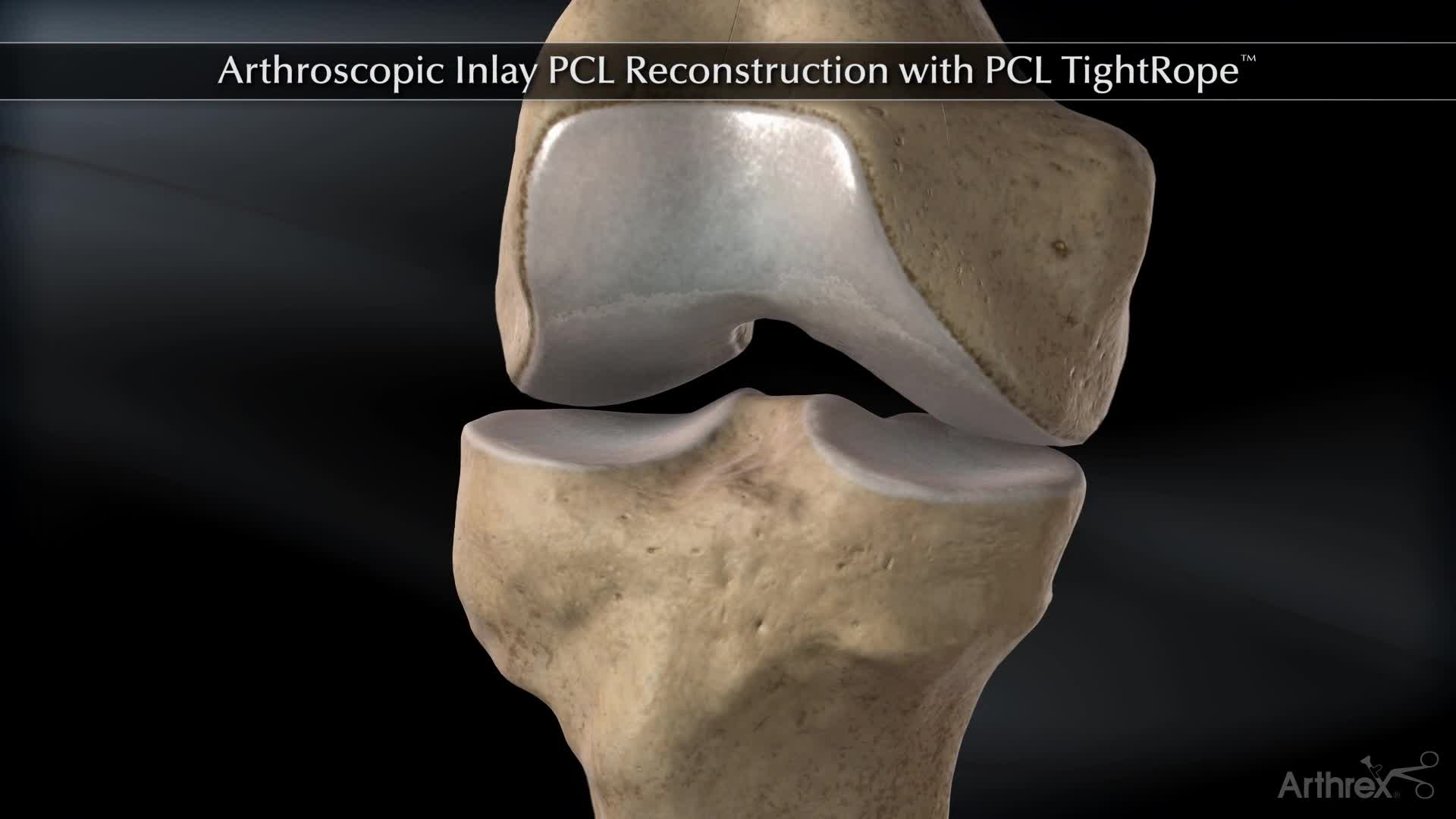 Arthrex - Arthroscopic Inlay PCL Reconstruction with PCL TightRope®