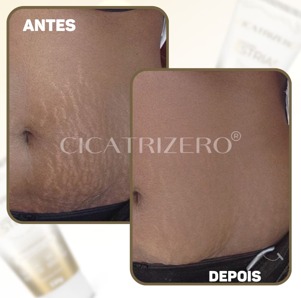4 Cicatrizero Tratamento para todos os tipos de Estrias