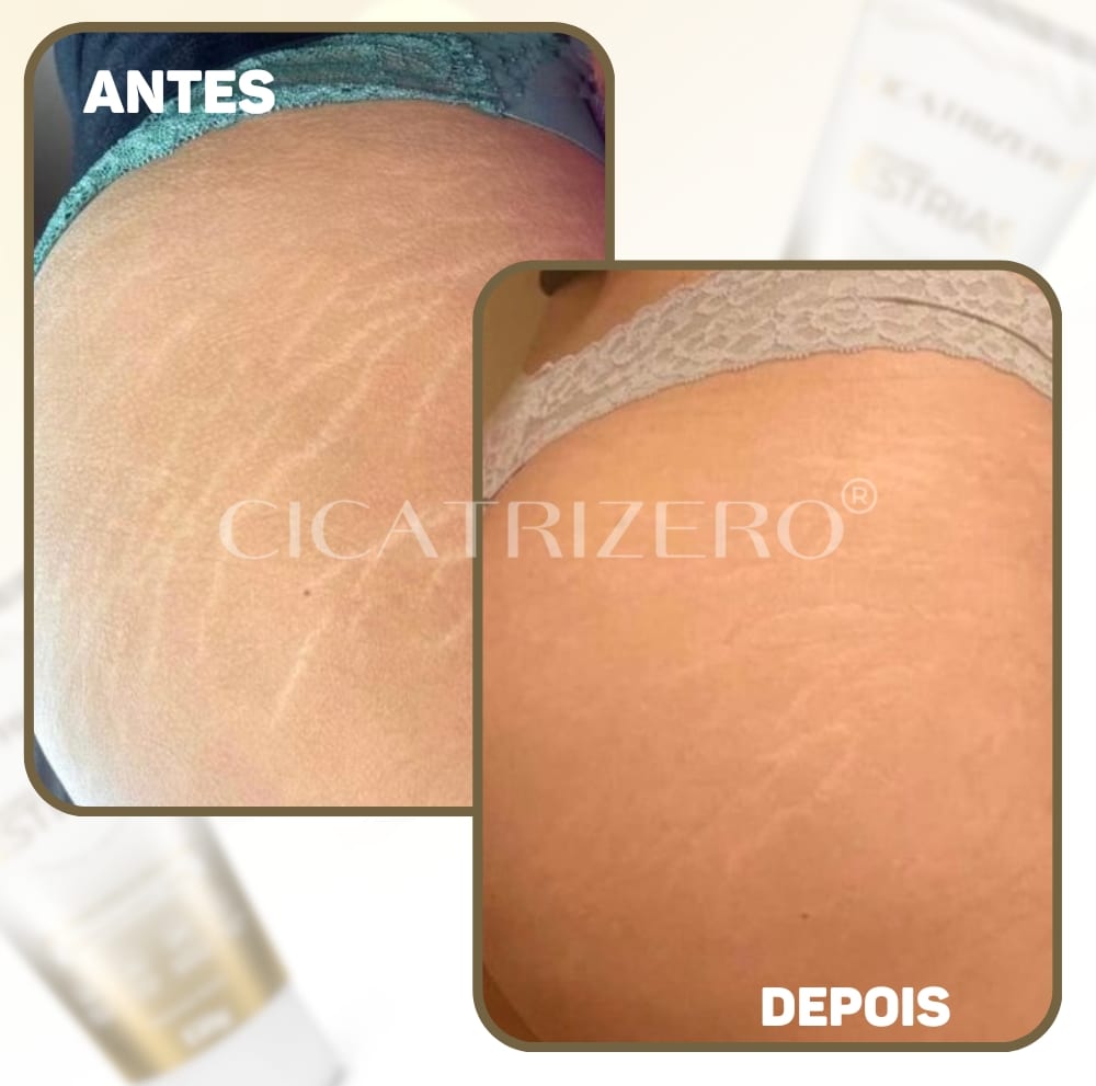 4 Cicatrizero Tratamento para todos os tipos de Estrias