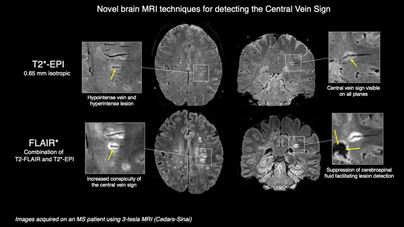A Clearer Picture of Multiple Sclerosis - Cedars-Sinai Pulse