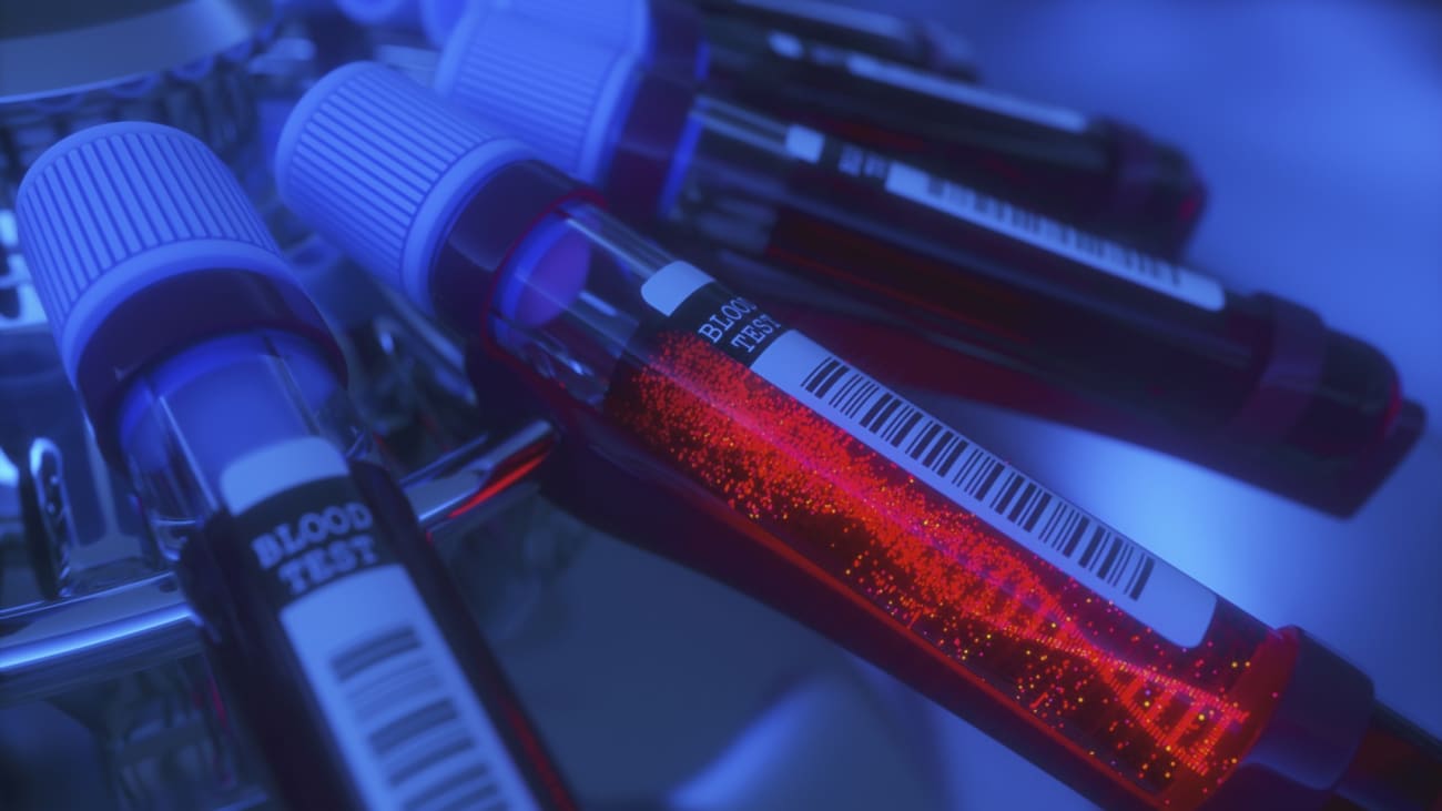 Invention: A Blood Test to Unlock Prostate Cancer Mysteries - Cedars ...