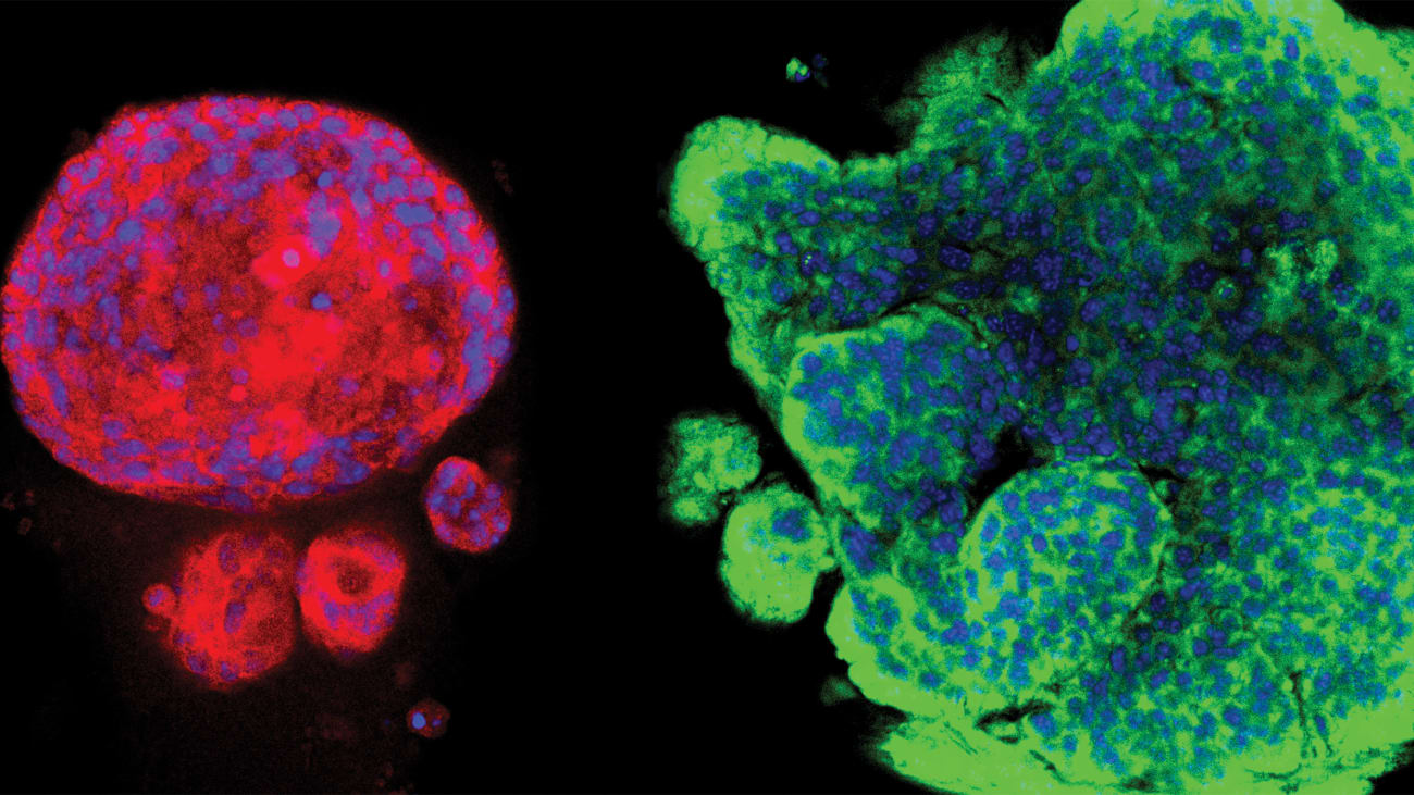 Clarifying the Mechanics of Brain Metastasis in Breast Cancer - UT ...