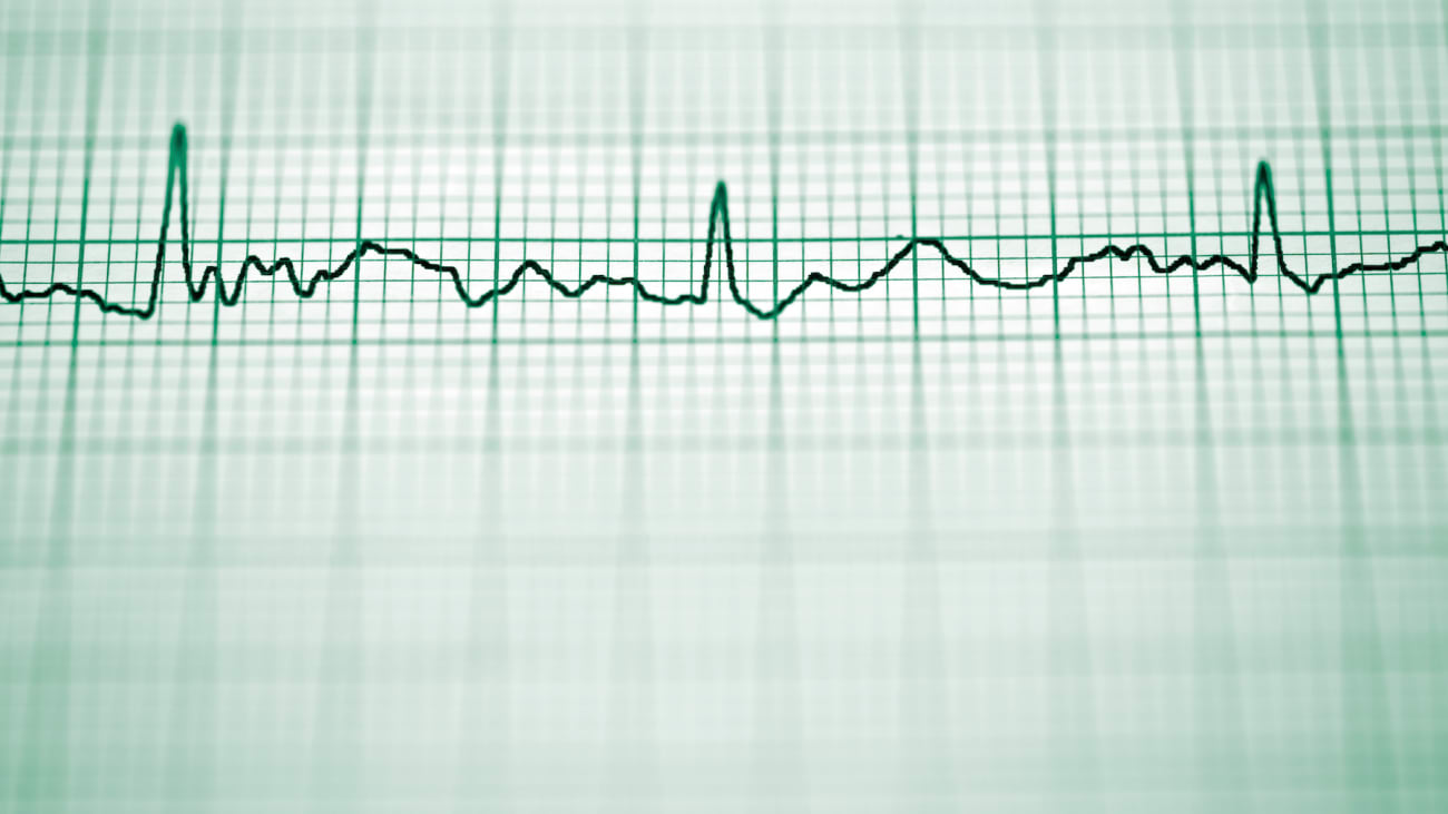 Using AI in Electrocardiogram Analysis Can Improve Diagnosis and ...