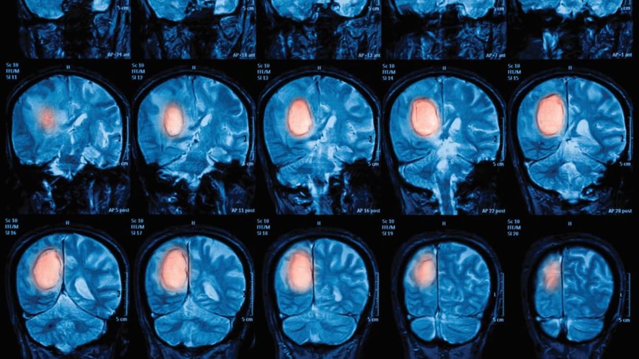 Advancing the Treatment of Brain Tumors - UT Southwestern Medical Center