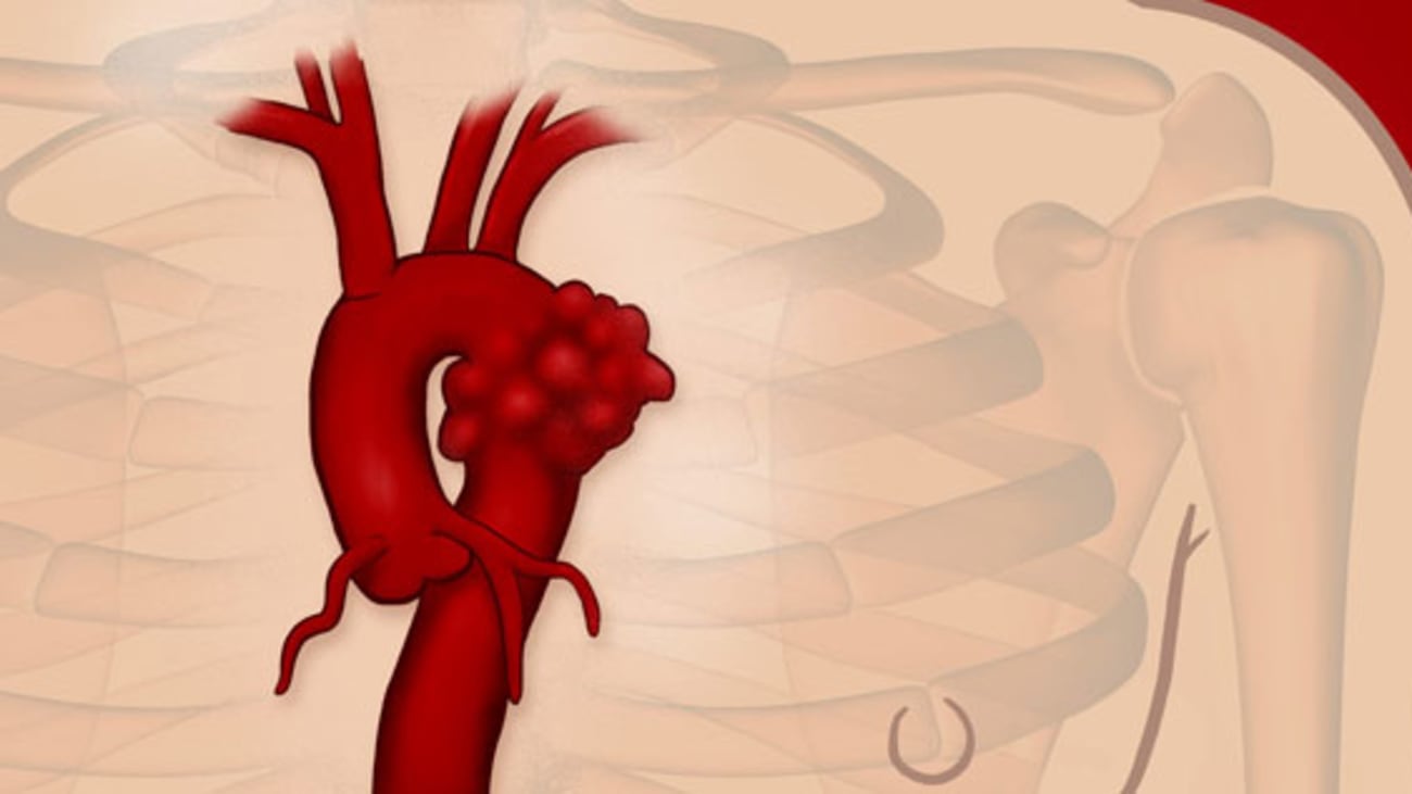 Repair of aortic transection after a motor vehicle crash - Keck ...