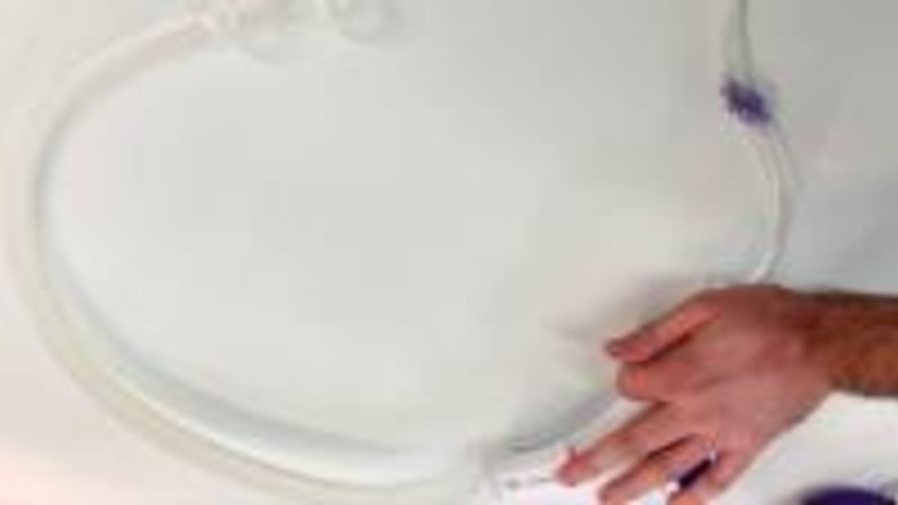 Endoscopic submucosal dissection of a laterally spreading tumor in the ...