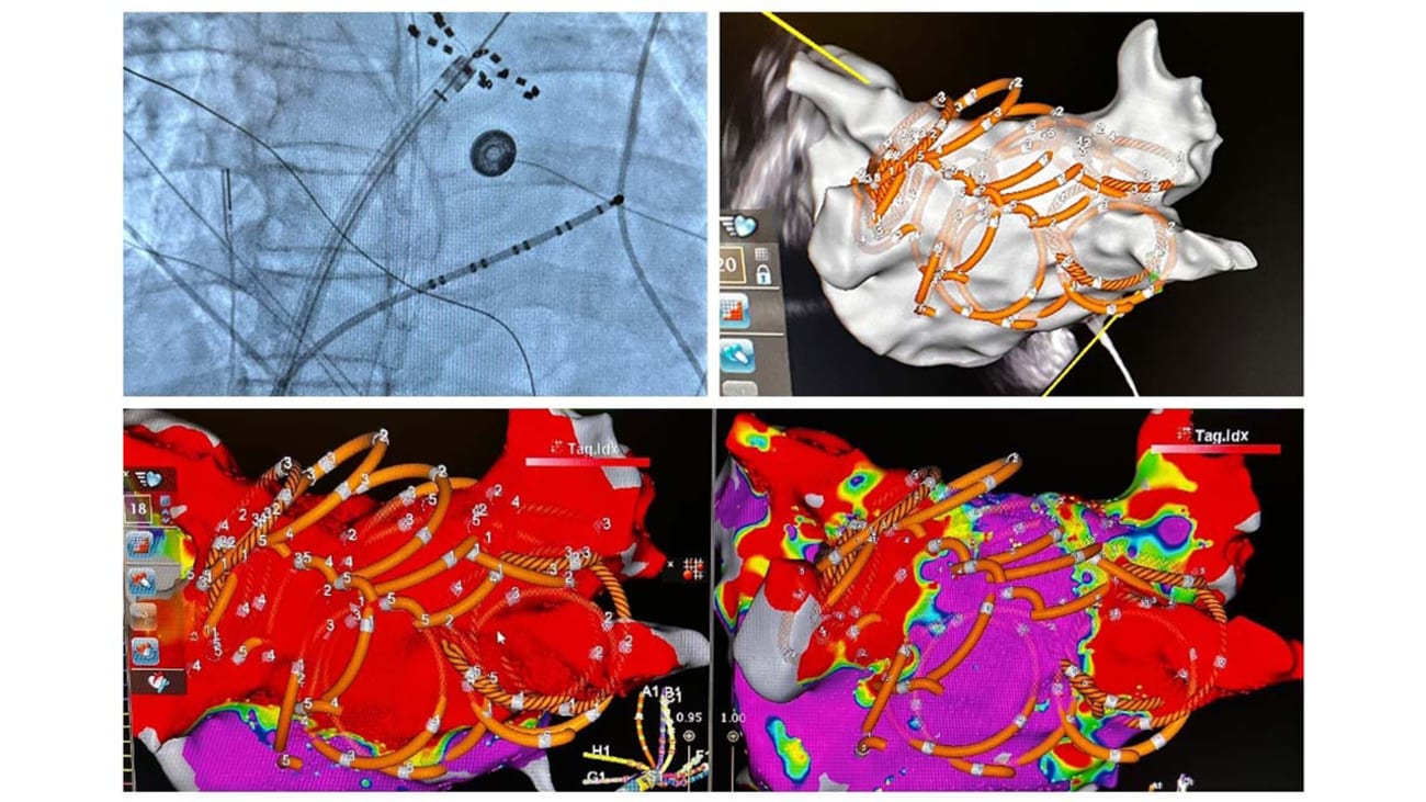 Is Pulsed Field Ablation as Promising as It Sounds? - Keck Medicine of USC