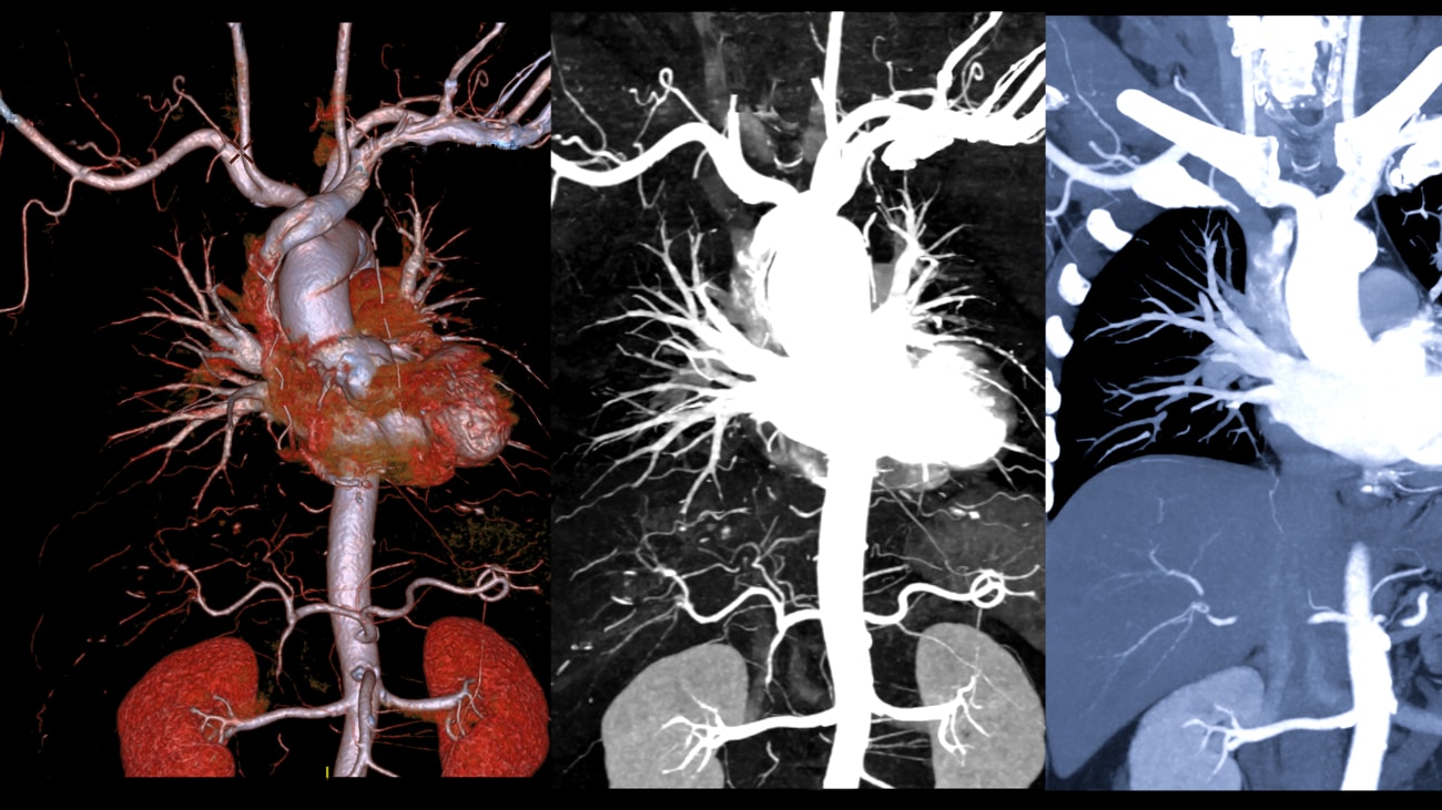 Role of Genetic Testing in the Management of Aortic Disease | Conexiant