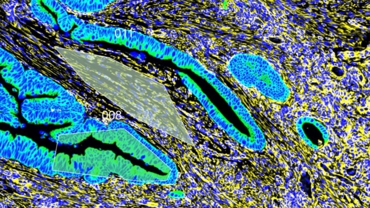 Stiffer colon could signal risk of early-onset colorectal cancer - UT ...
