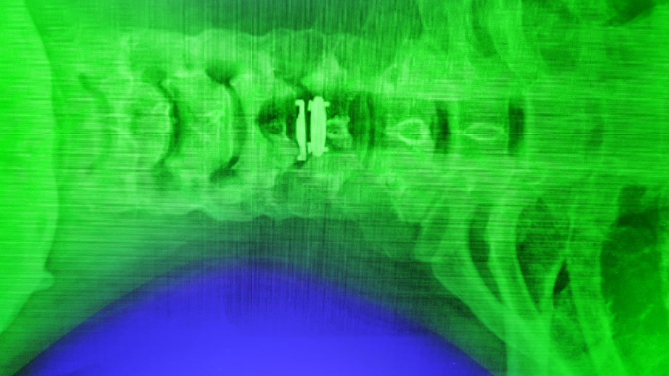 Spine - UT Southwestern Medical Center