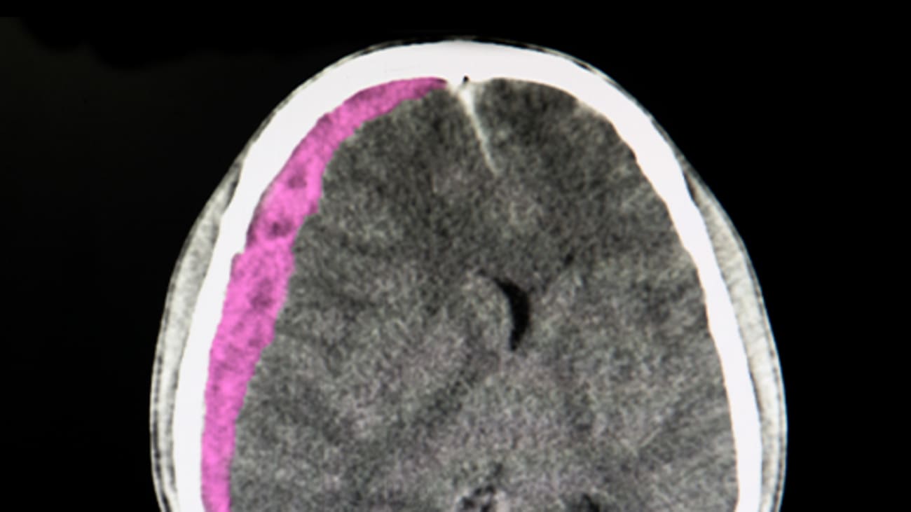 One of the First sites in U.S. to Study New Treatment for Subdural ...
