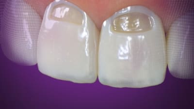 Restorative Dentistry Advances | Compendium