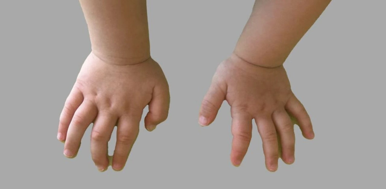 Triplication of Chromosome 3p24.3p23 in a Child with Autism: What's ...