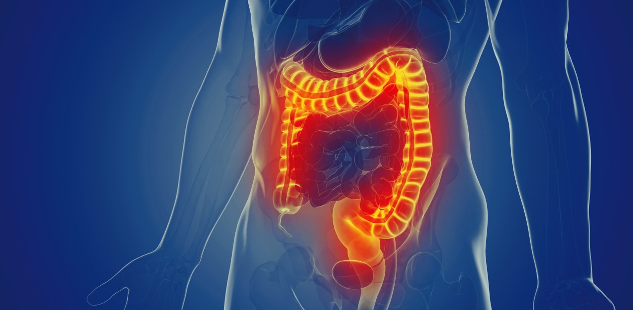 Mirikizumab shows promise for kids with ulcerative colitis | Conexiant