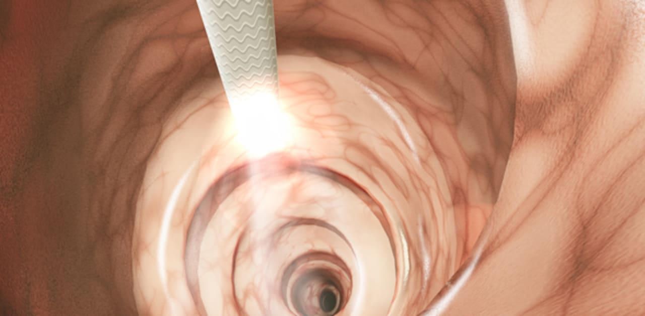 Improving Monitoring of Postoperative Crohn’s Disease Recurrence ...