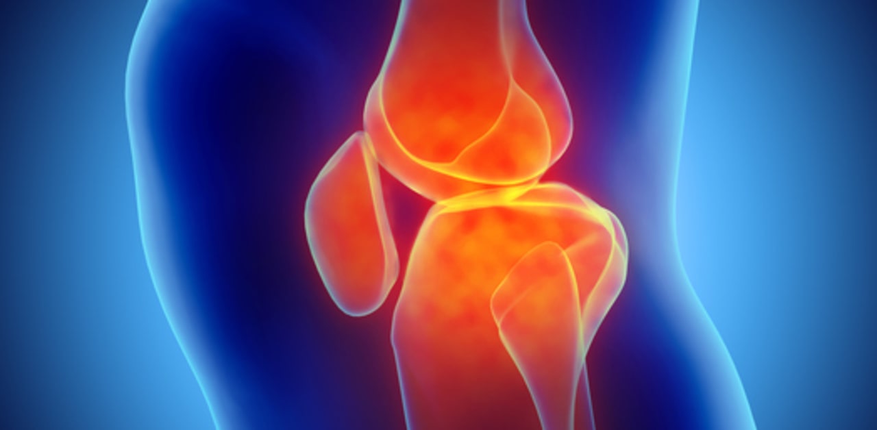 Evaluating IPFP Steroid Injections in OA | Conexiant