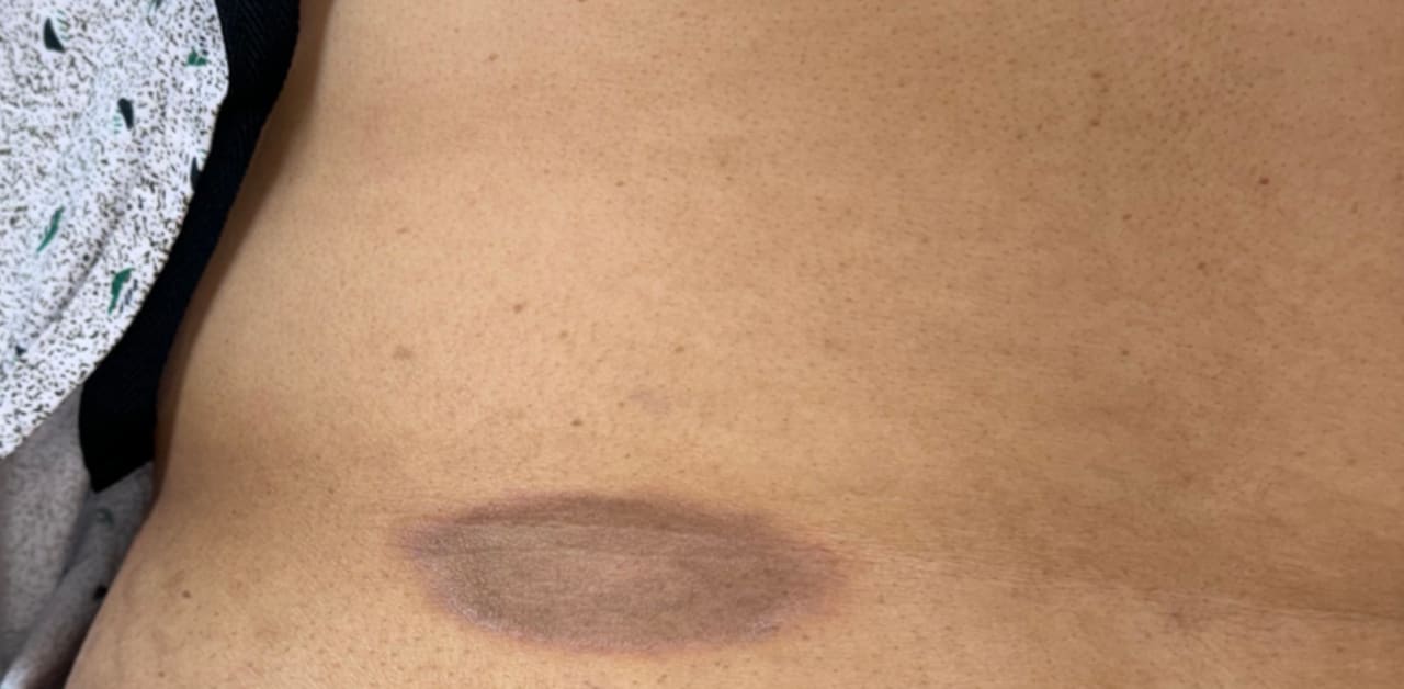 Recurrent Hyperpigmented Patches After GLP-1 Therapy: What's Your ...