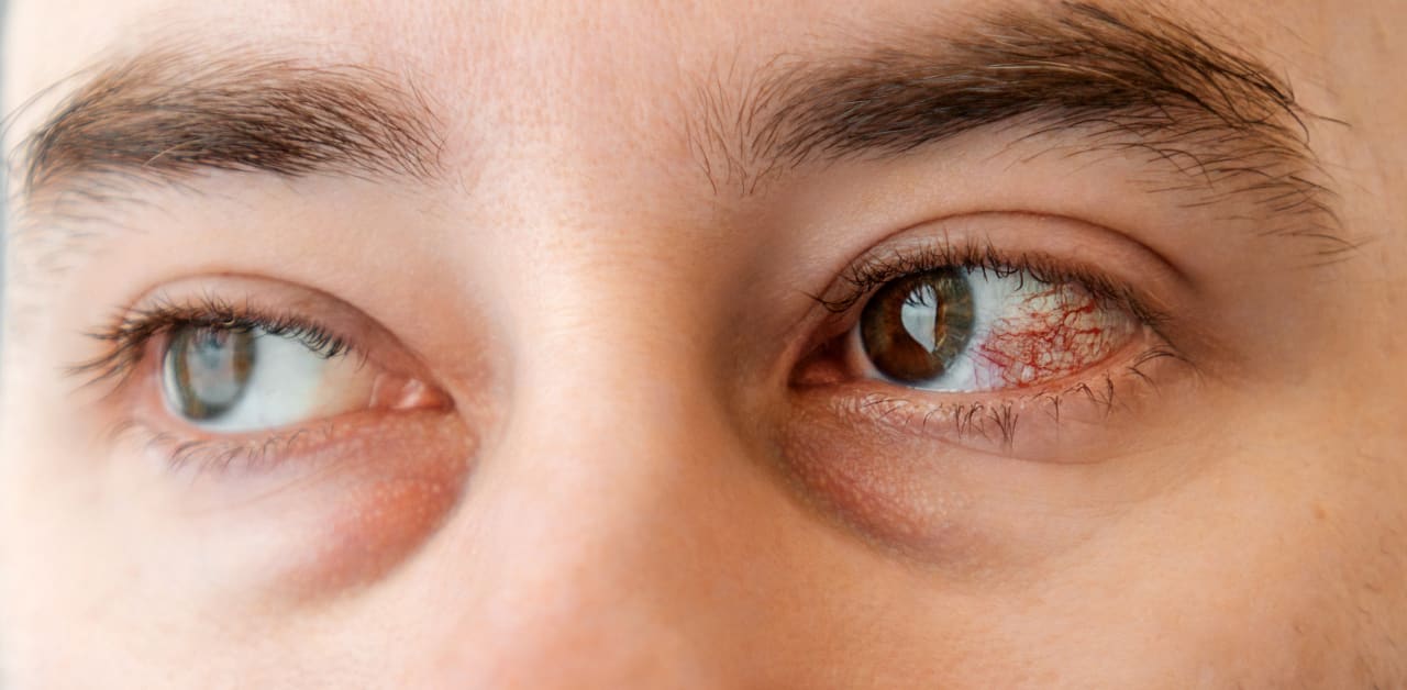 Ocular Rosacea: The Often-Overlooked Component of Rosacea | Conexiant