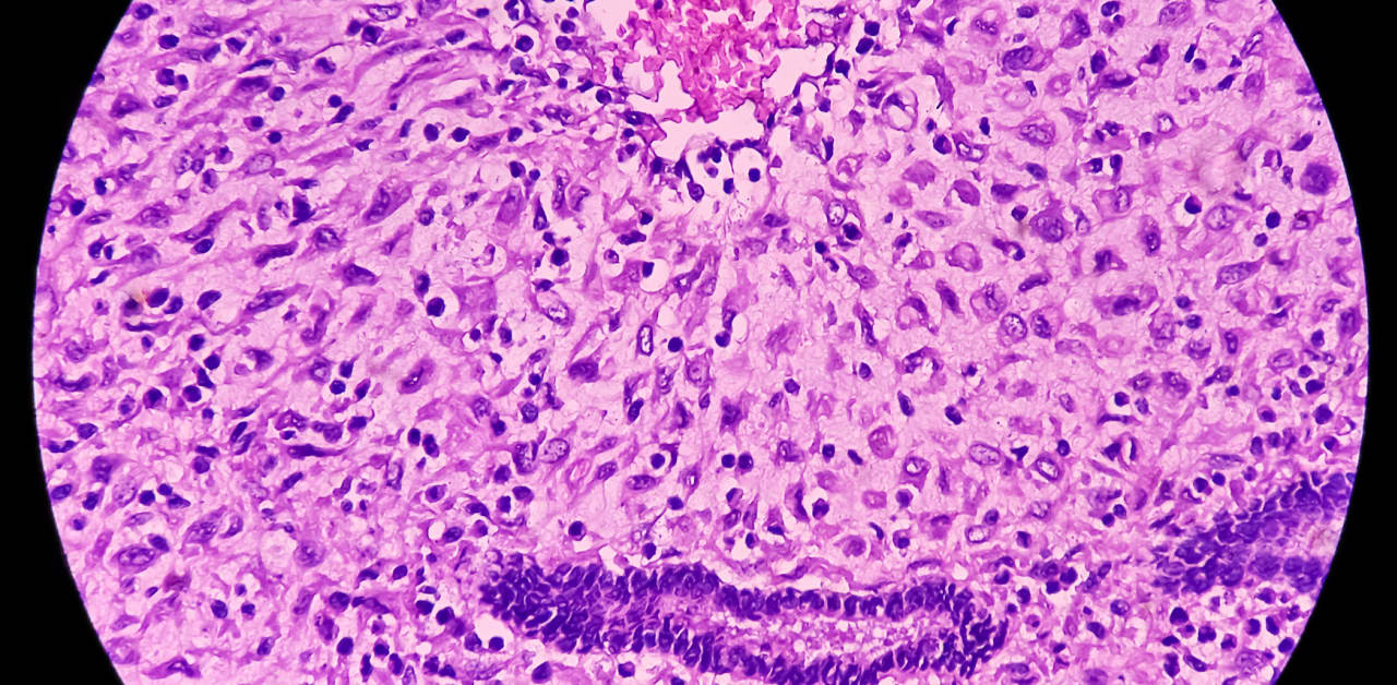 Tampon Test May Detect Endometrial Cancer Conexiant tampon-test-may-detect-endometrial-cancer-conexiant