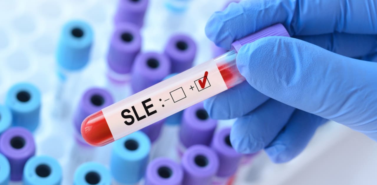 Lupus Clusters Show Distinct Disease Patterns | Conexiant