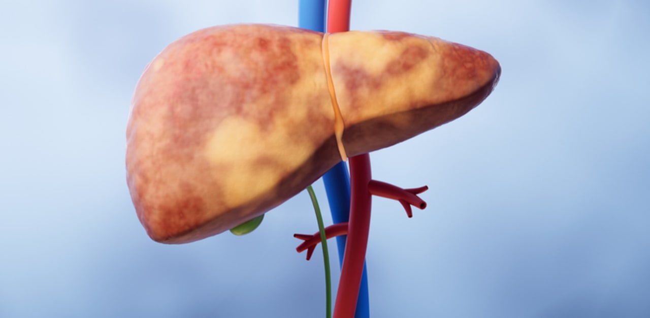 Summary - Bariatric Surgeries Reverse Liver Fibrosis | Conexiant