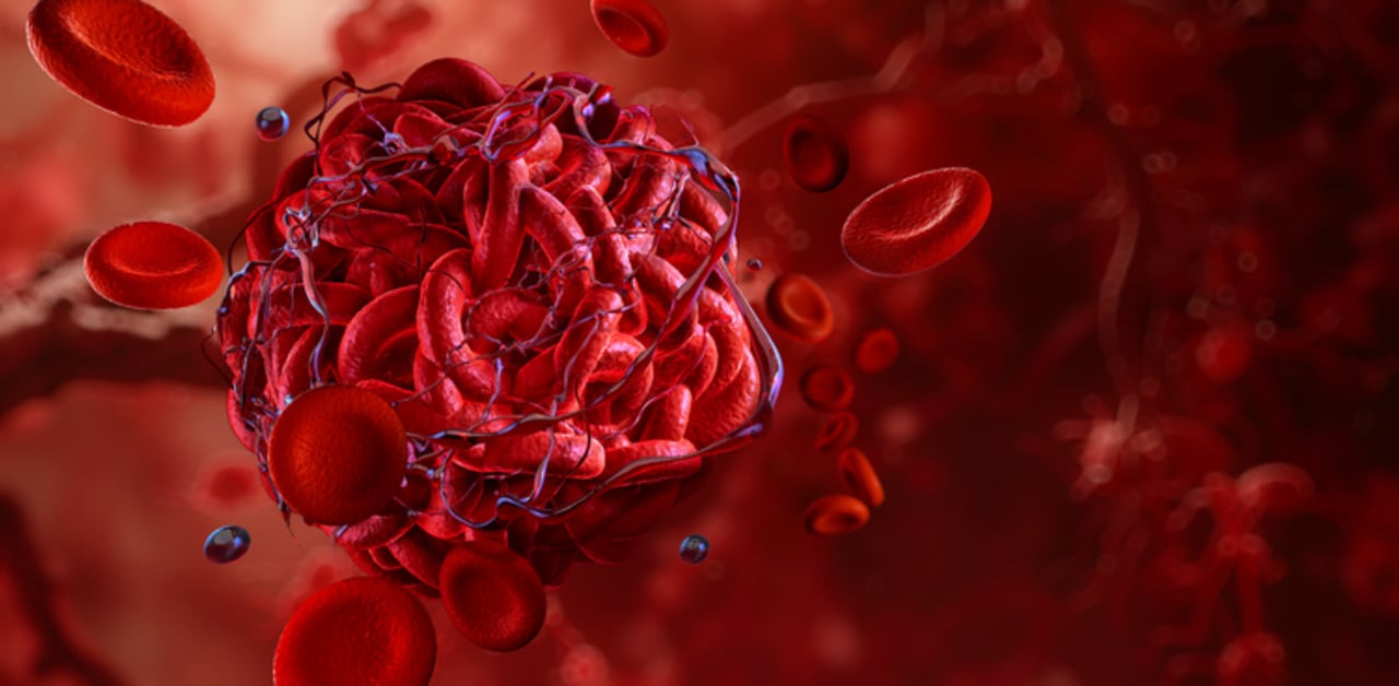 Can a Flexible Thrombectomy Device Clear Venous Clots? | Conexiant