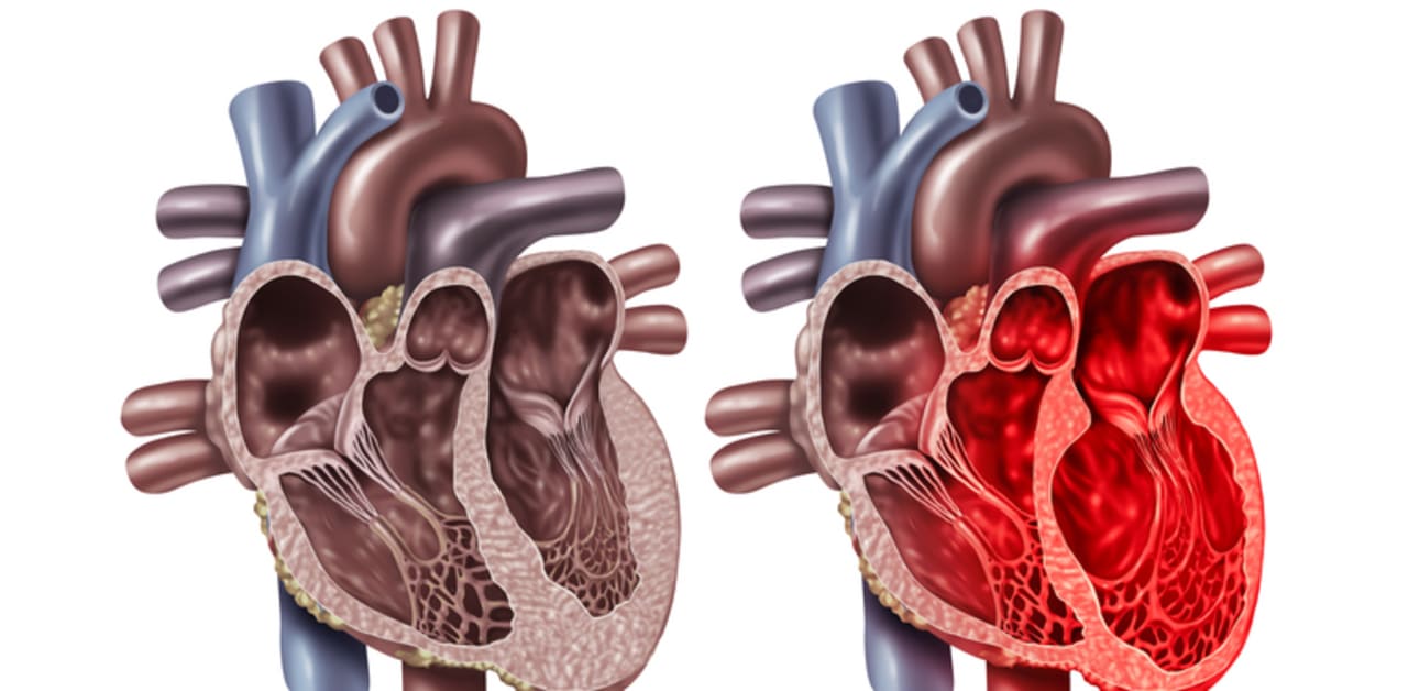 Men With Broken Heart Syndrome Have Twice the Mortality Risk: Study ...