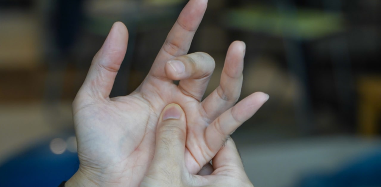 Trigger Finger: More Than Just A1 Pulley Pathology | Conexiant