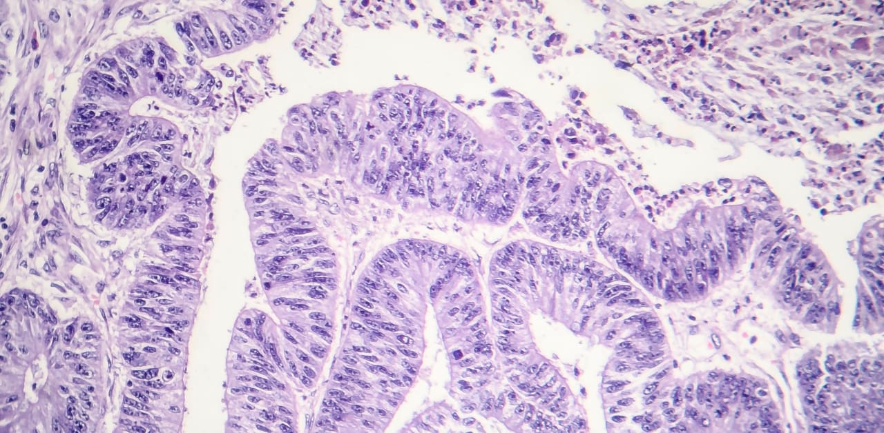 AGA releases updated guideline on endoscopic surveillance of Barrett’s ...