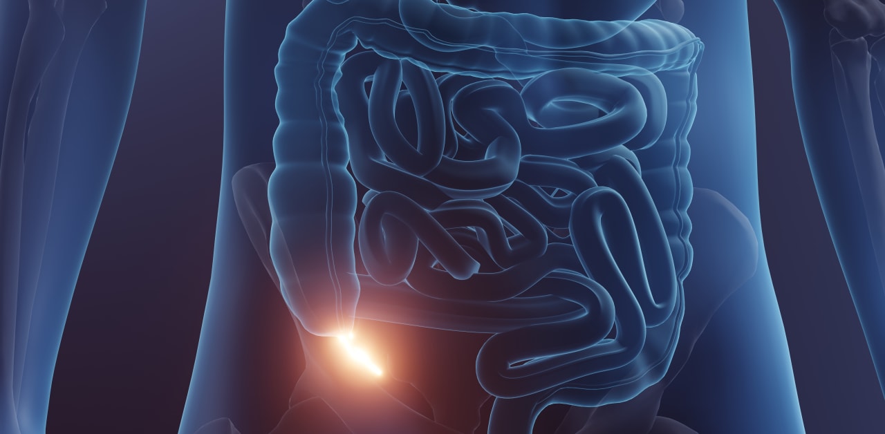 Appendectomy May Lower Risk of Colorectal Cancer Subtype | Conexiant