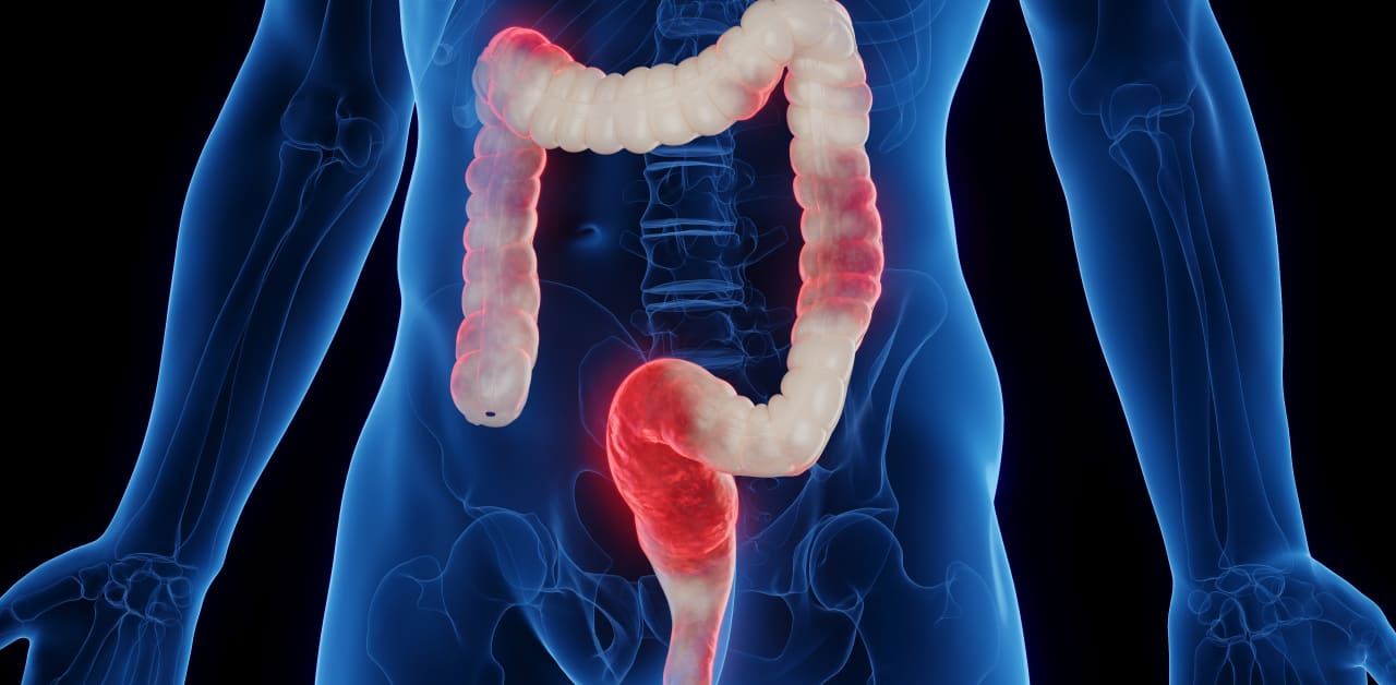 Evidence-Based Guidance for Managing Hemorrhoidal Disease | Conexiant