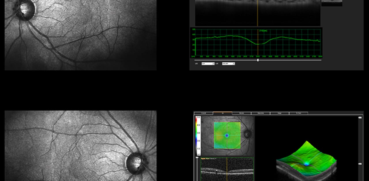 The Retina as a Window to Alzheimer’s: Study Highlights Key Microglial ...