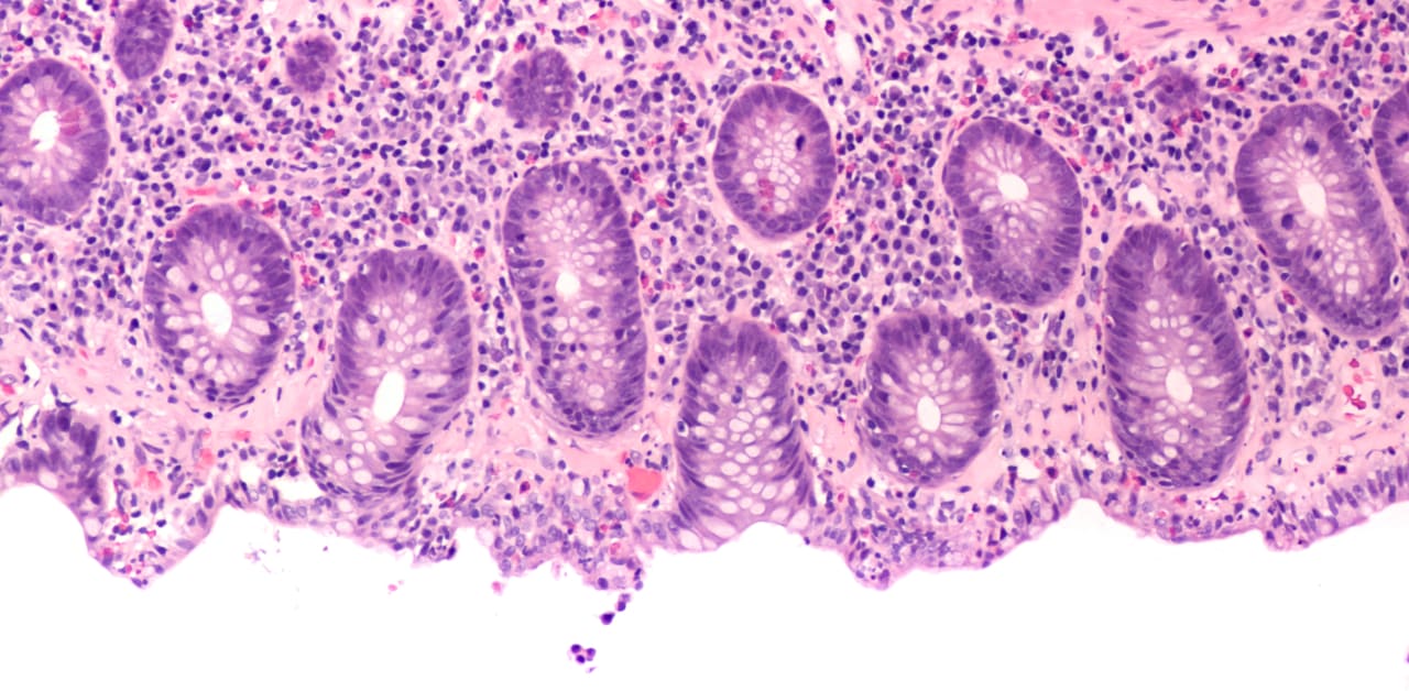 Symptom Burden Among Patients With Microscopic Colitis | Conexiant