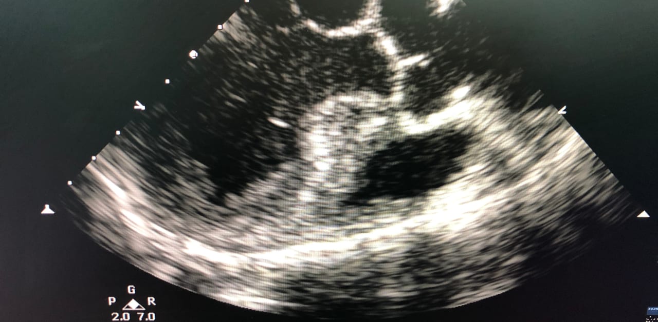 AI-Based Platform May Predict Rheumatic Heart Disease Development ... AI-Based Platform May Predict Rheumatic Heart Disease Development ...