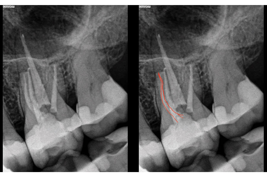 Use of a Single-File Reciprocating R20 in a Complex Retreatment | Conexiant