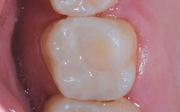Achieving Longevity in Posterior Composite Restorations | Inside Dentistry