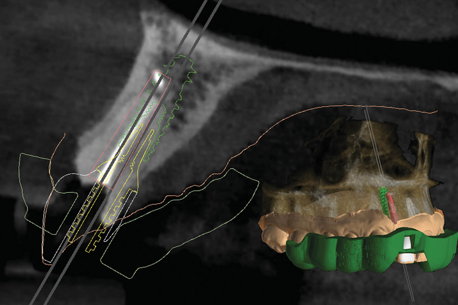 Guided Selective Preservation of Tooth (SPOT) Protocol: Fully Guided ...
