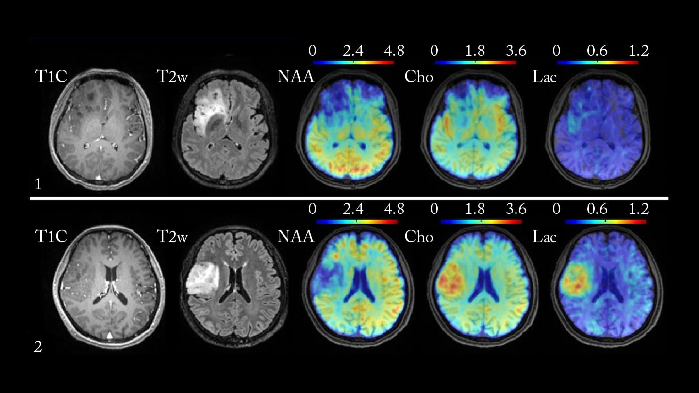 The Analytical Scientist | New MRI Method Maps Brain Metabolism in Minutes