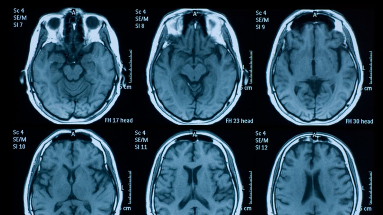 Updates on Multiple System Atrophy - Medical Professional Education Center