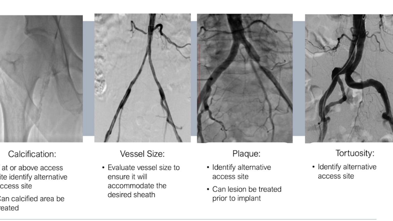 Access and Groin Management: The Use of Ultrasound for Vascular Access ...
