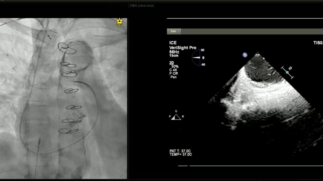 Complex TAVR in a Patient with Multisystem Failure - Sentara