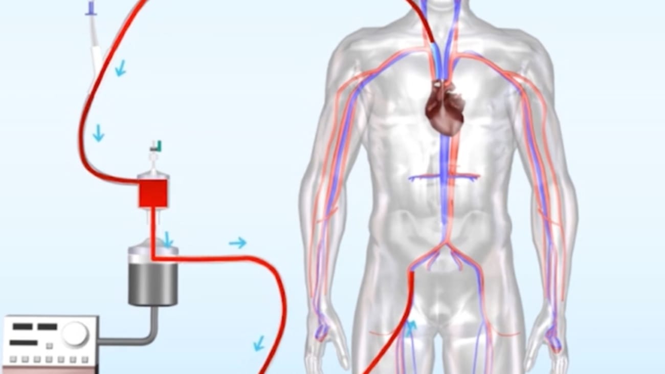 AngioVac Procedure: Treatment for Deep Venous Thrombosis - Medical Professional Education Center