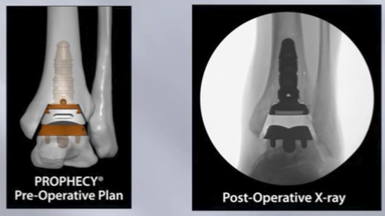 PROPHECY™ INBONE™ Total Ankle System Surgical Technique Animation ...